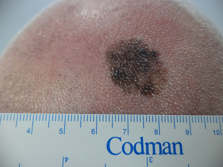 Types of Skin Cancer | Northern Sun Skin Cancer Clinic